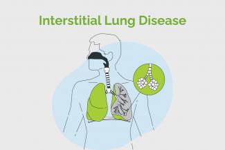Overview of Interstitial Lung Disease| PatientsEngage
